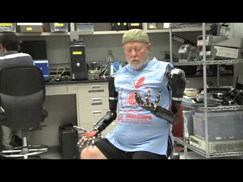 The Bionic Arm That Changed This Man's Life | BeWellBuzz